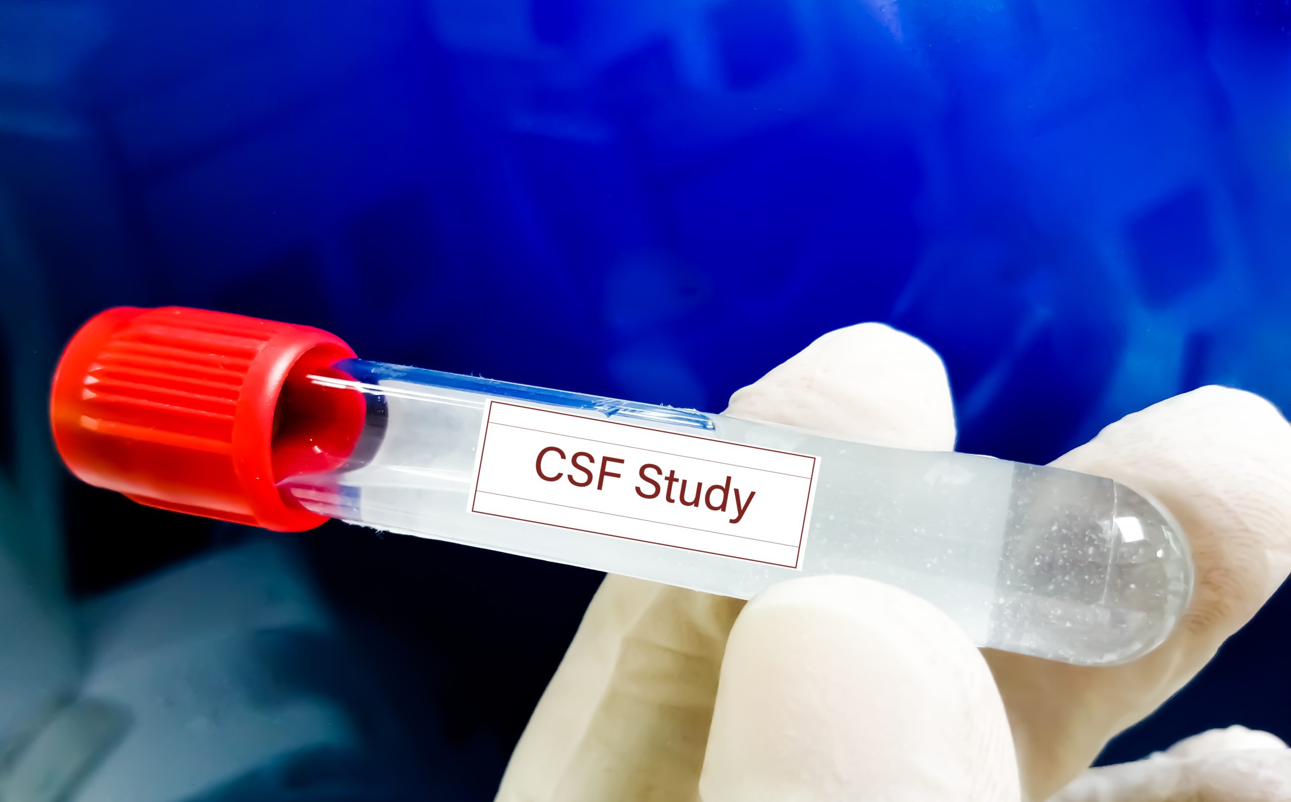 All About Cerebral Spinal Fluid (CSF) Donation - National Ataxia Foundation